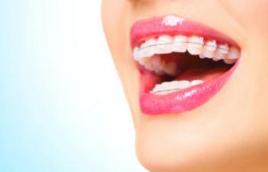 What Will You Do When Your Braces Come Off?