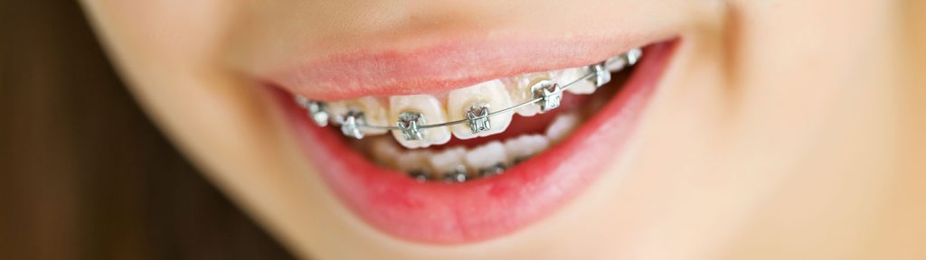 Self-Ligating Braces - Broad Street Braces - Orthodontist Philadelphia
